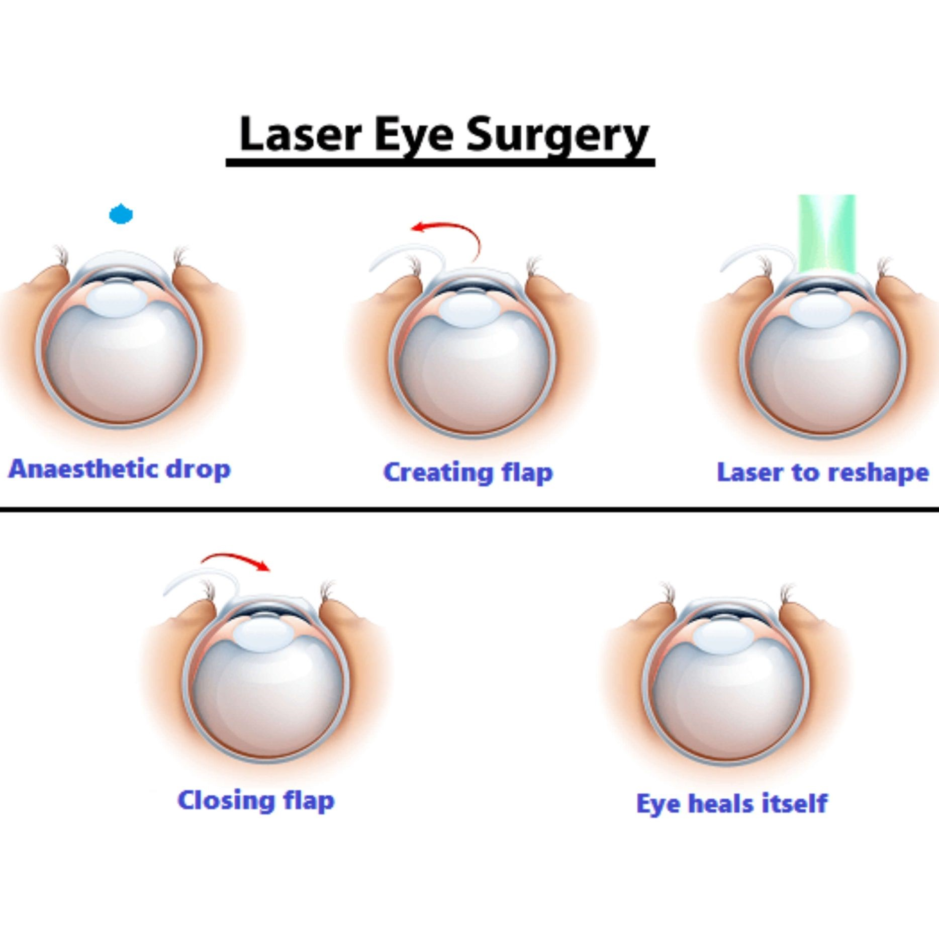 Refractive surgery/ LASIK – Sonovision Hospital